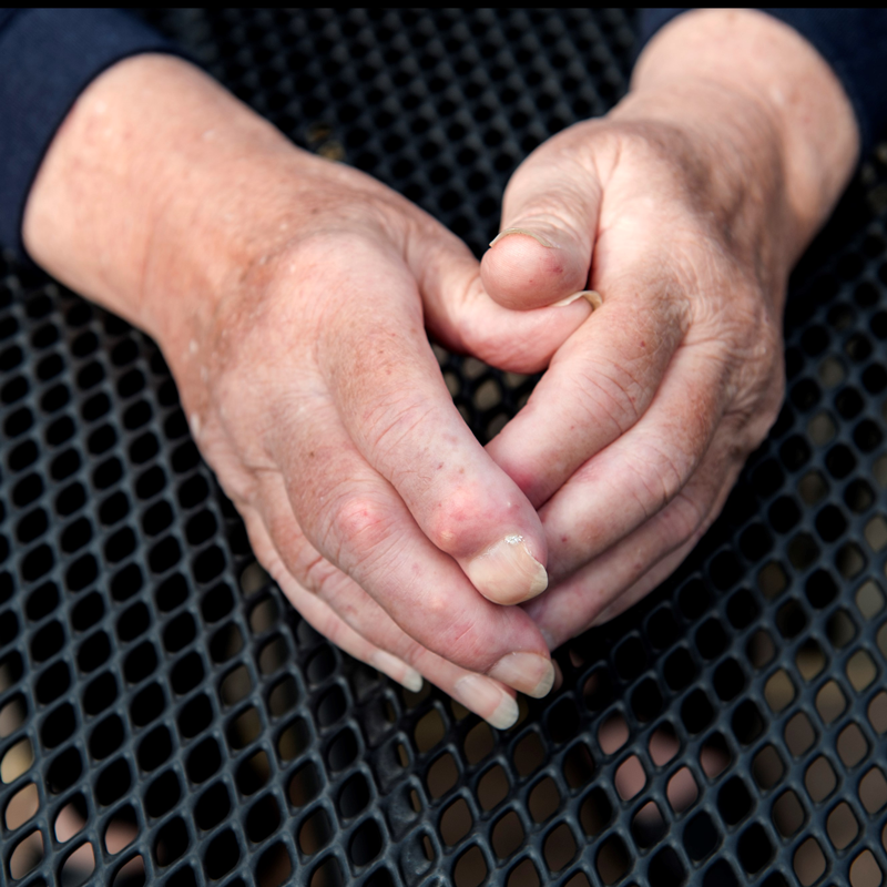 CE - Conoce la esclerodermia | Síntomas de la esclerodermia